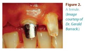 Benefit of Ferrule or Post in Endodontically Treated Teeth - BC Endo